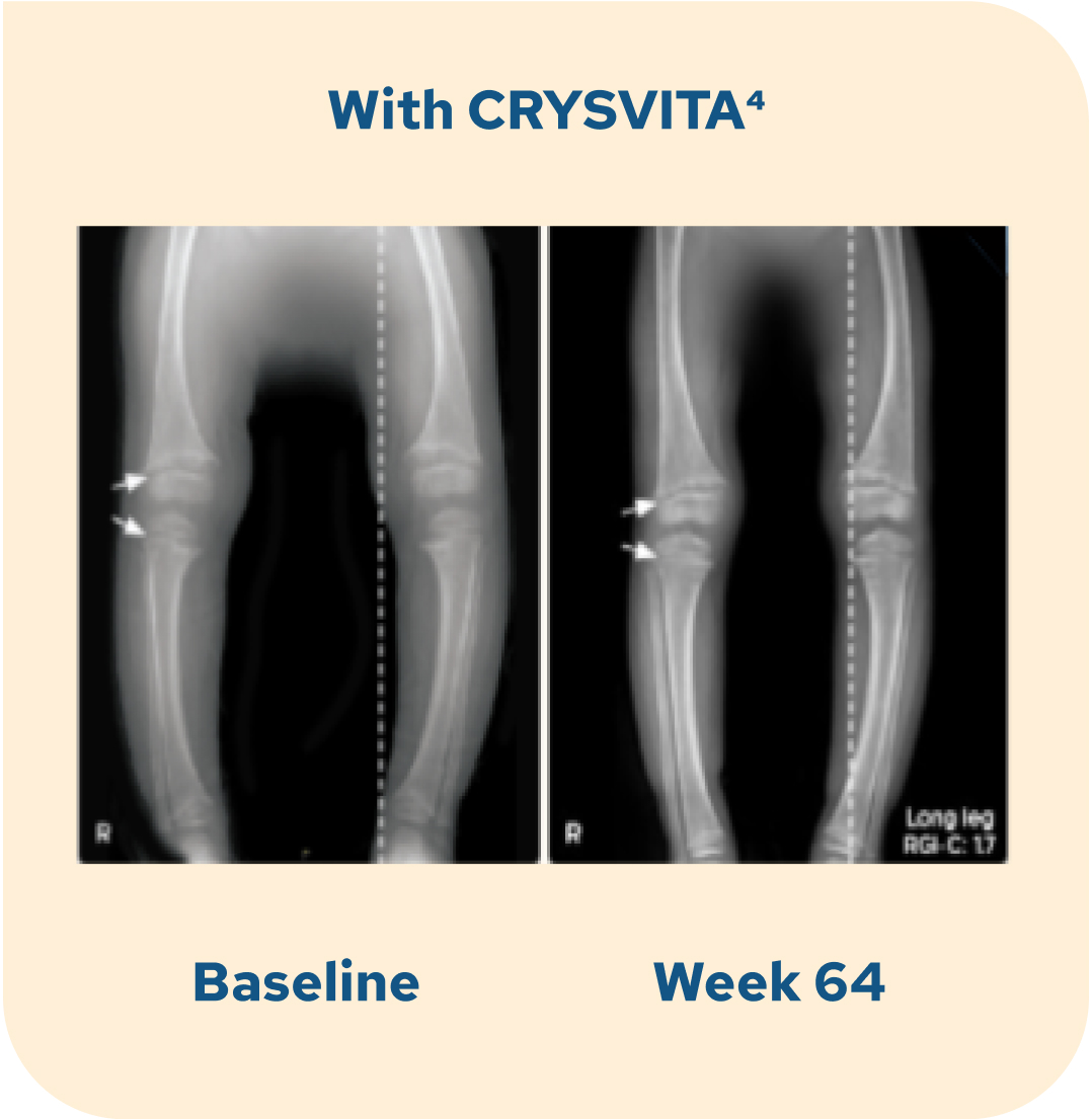 Efficacy in children | CRYSVITA® (burosumab-twza)